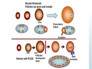 PCOD Details - A guide to learn more about PCOD | PDF