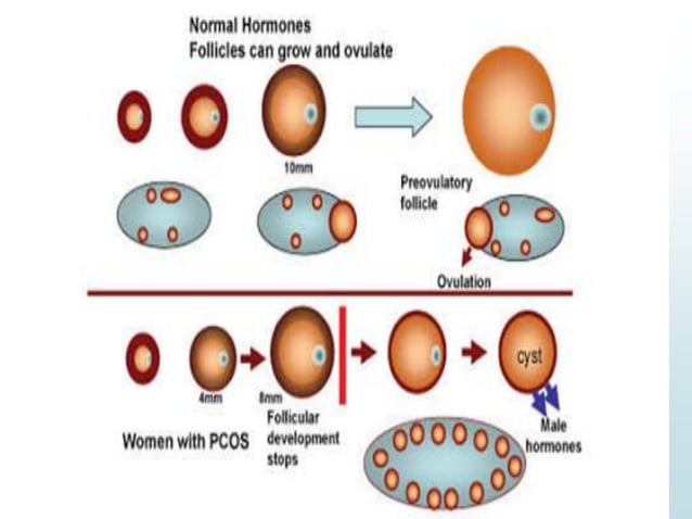 PCOD Details - A guide to learn more about PCOD | PDF | Hormonal ...