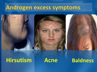 PCOD (Polycystic Ovarian Disease) | PPT