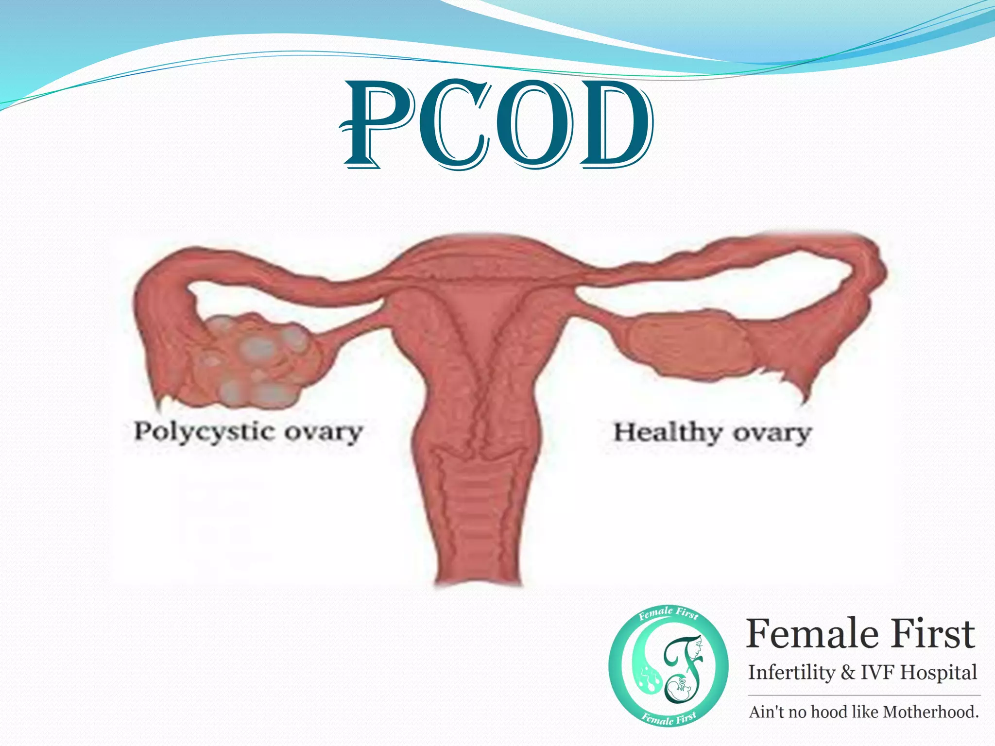 PCOD Presentaion | PDF | Hormonal Disorders | Endocrine and Metabolic Diseases