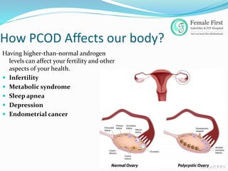 Pcod presentation converted | PPT