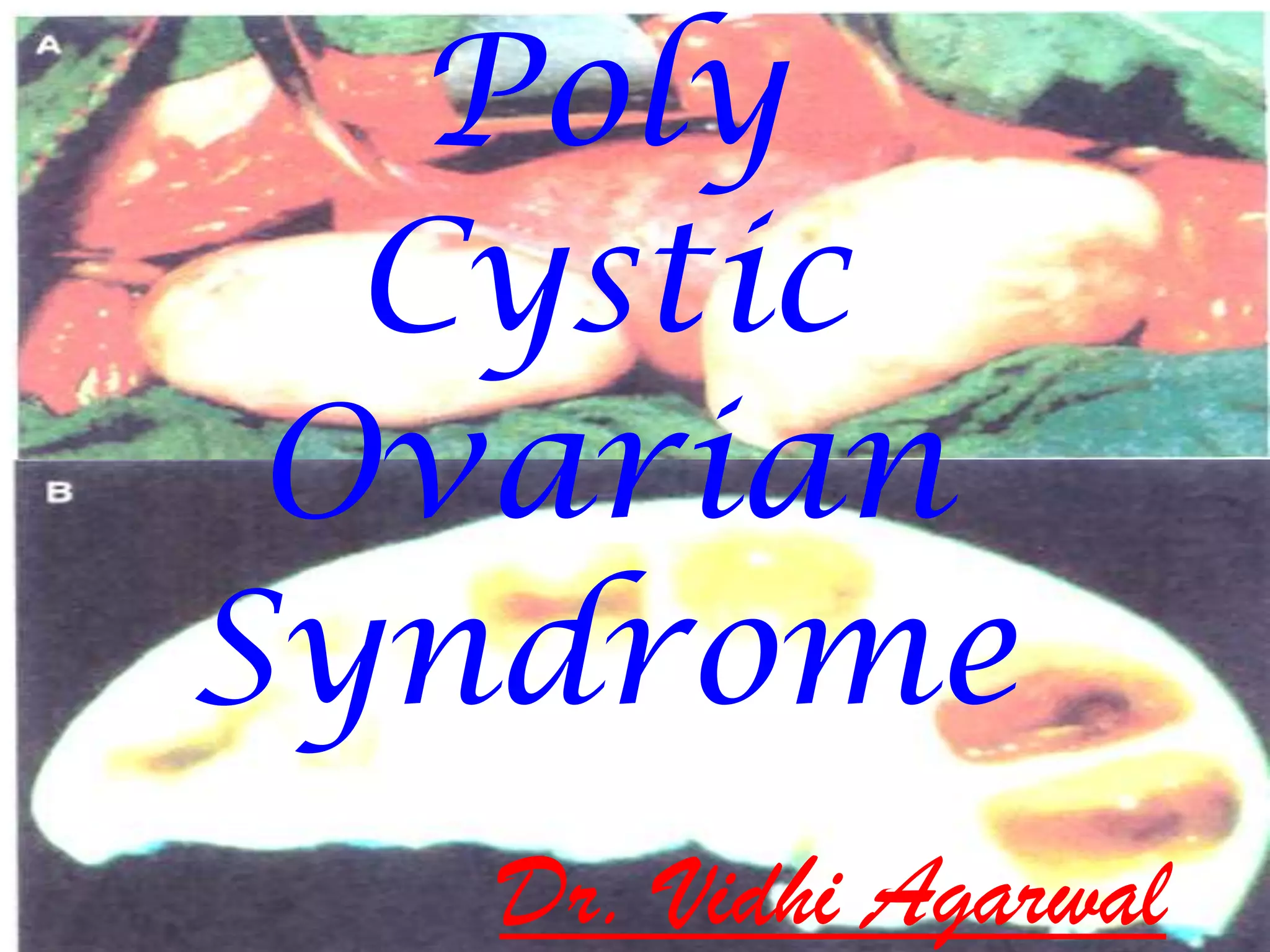 Poly Cystic Ovarian Syndrome By Dr. Vidhi Agarwal | PPT