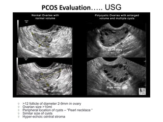 Pcos | PPTX