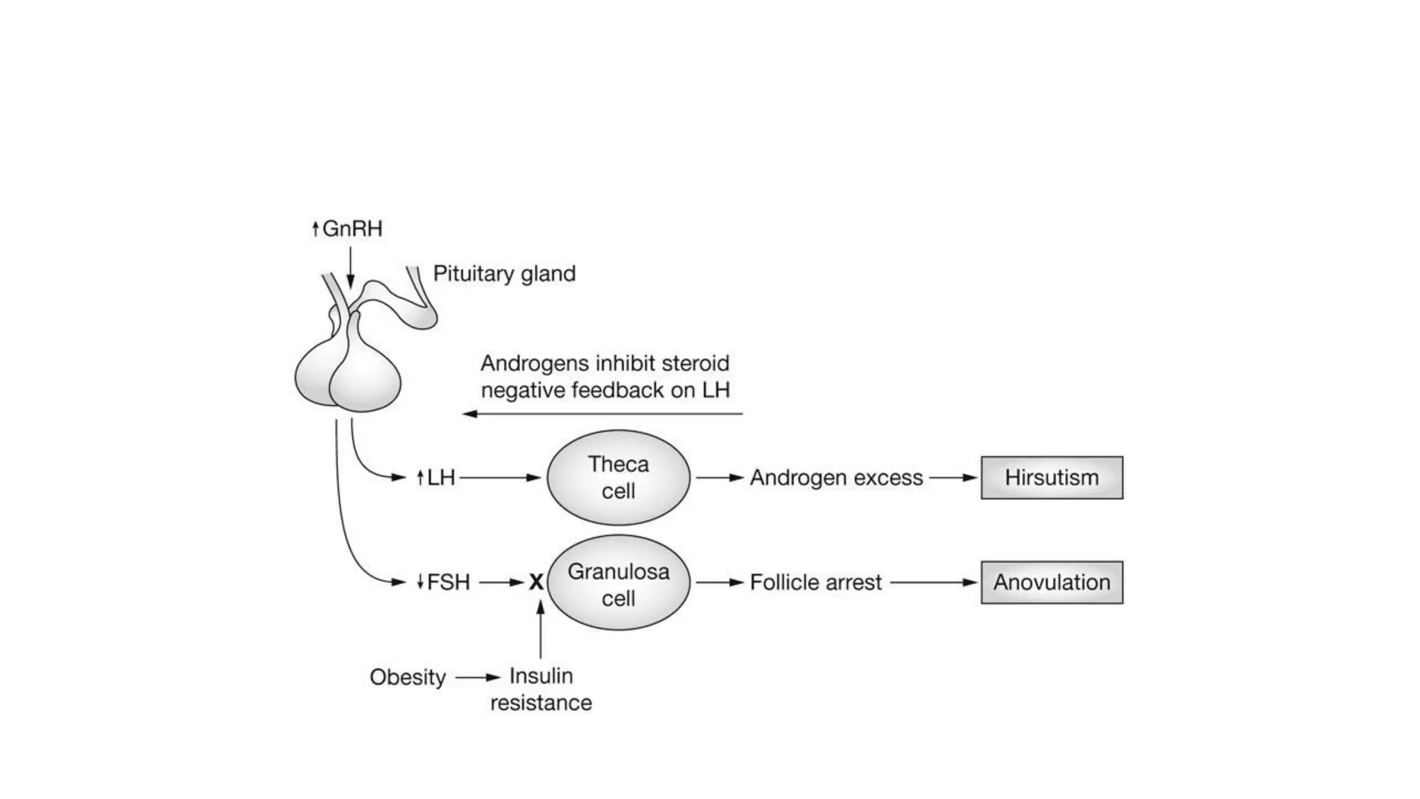 Polycystic ovarian disease revision notes (PCOD) | PDF
