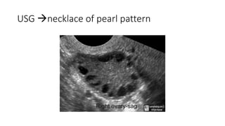 Polycystic ovarian disease revision notes (PCOD) | PDF | Hormonal ...