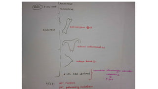 Polycystic ovarian disease revision notes (PCOD) | PDF