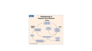 Polycystic ovarian disease revision notes (PCOD) | PDF