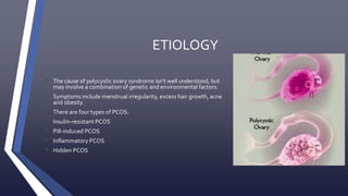 PCOS (polycystic ovarian syndrome) | PPTX