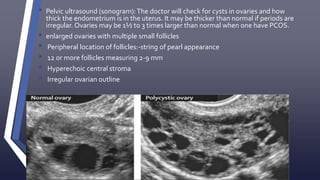 PCOS (polycystic ovarian syndrome) | PPTX