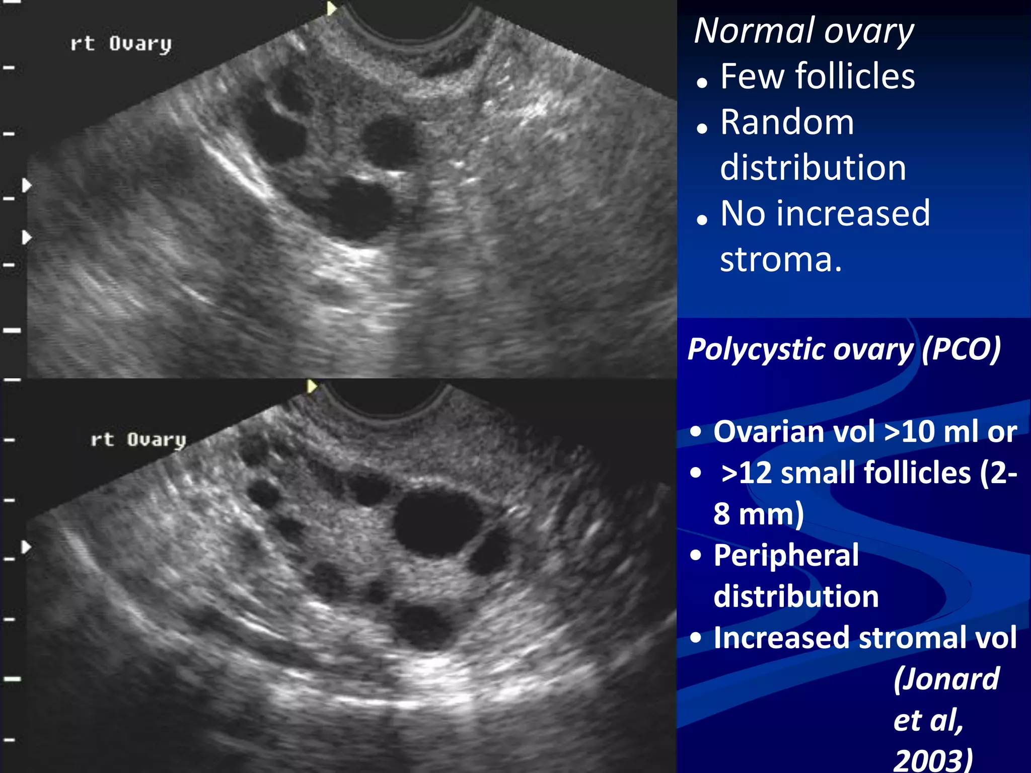 Hormonal evaluation and management of Polycystic Ovarian Syndrome (PCOS ...