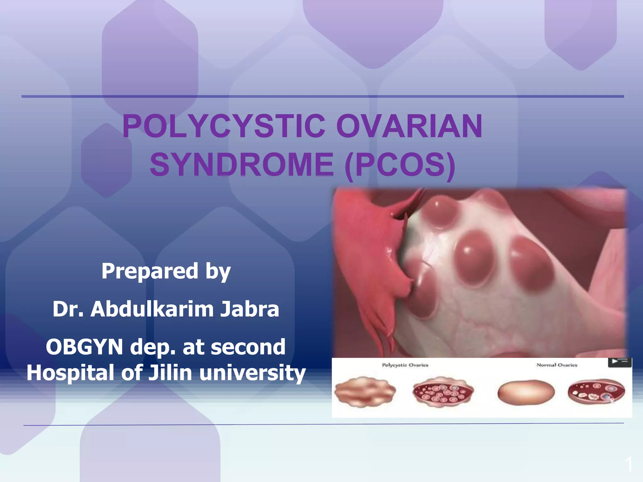 Polycystic Ovarian Syndrome/PCOS | PPT