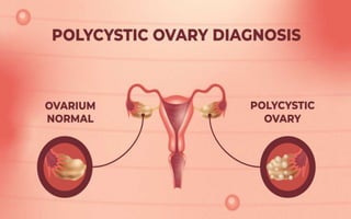 PCOS.pptx