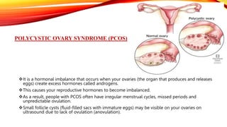 PCOS.pptx