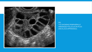 Pcospcos pcos pcos pcos pcos pcos pcos.pptx