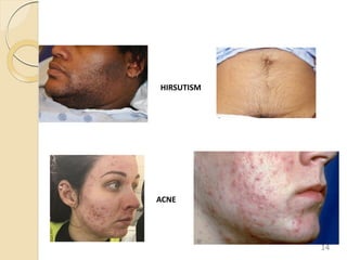 PCOS polycystic ovarian syndrome presentayiom | PDF