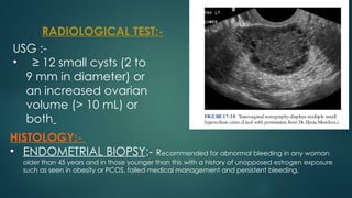 polycystic ovarian syndrome aka PCOS.pptx