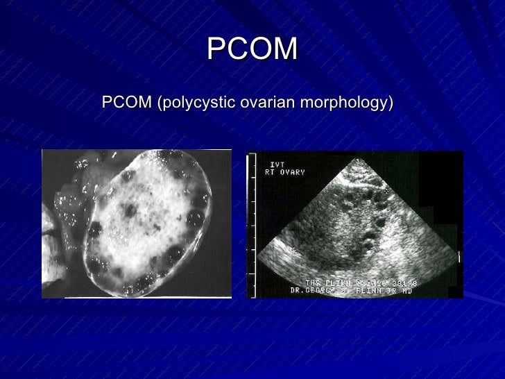 Infertility and PCOS