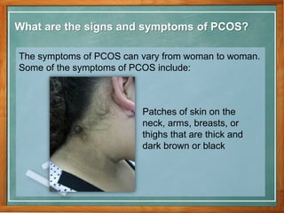 PCOS patient education | PDF