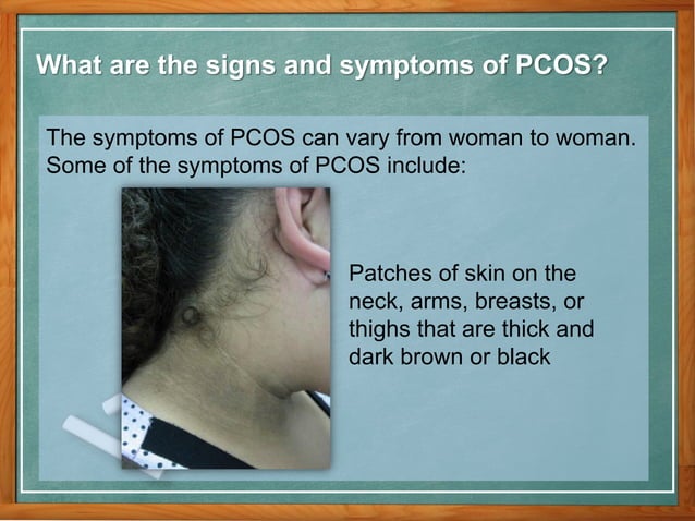 PCOS patient education | PDF