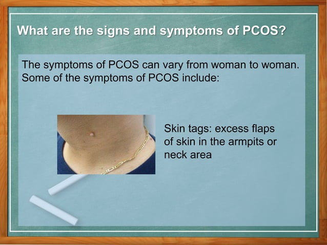 PCOS patient education | PDF