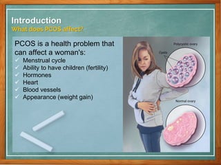 PCOS patient education | PDF