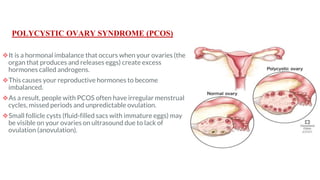 PCOS | PPTX