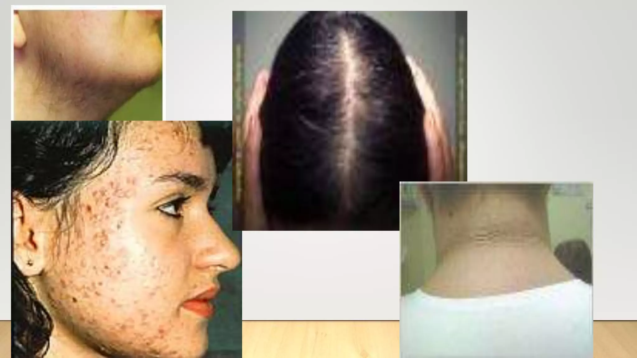 Polycystic ovarian disease (PCOS) | PPTX | Infertility | Reproductive ...