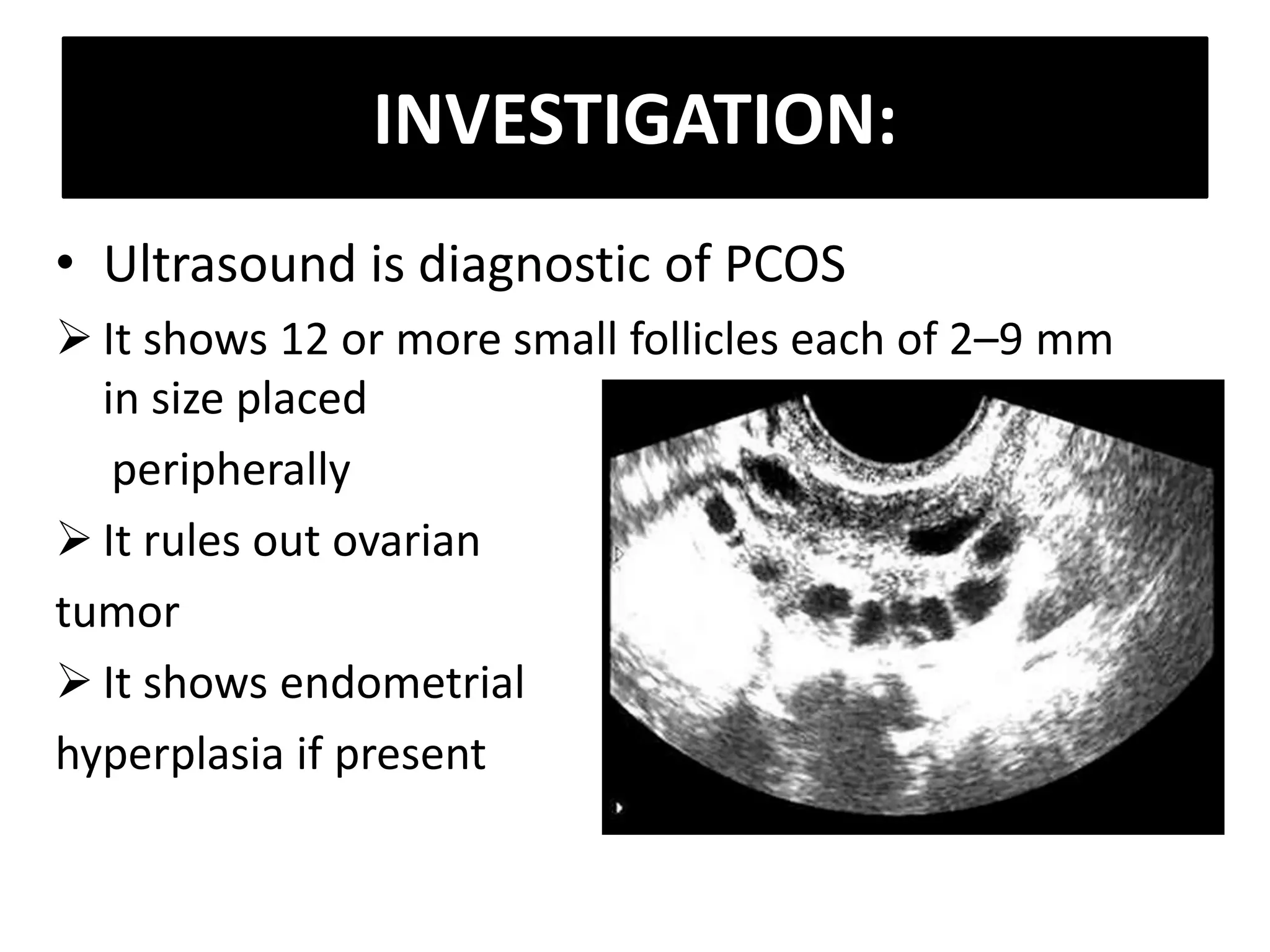 Polycystic Ovarian Syndrome (PCOS) by Dr. Aryan | PPTX
