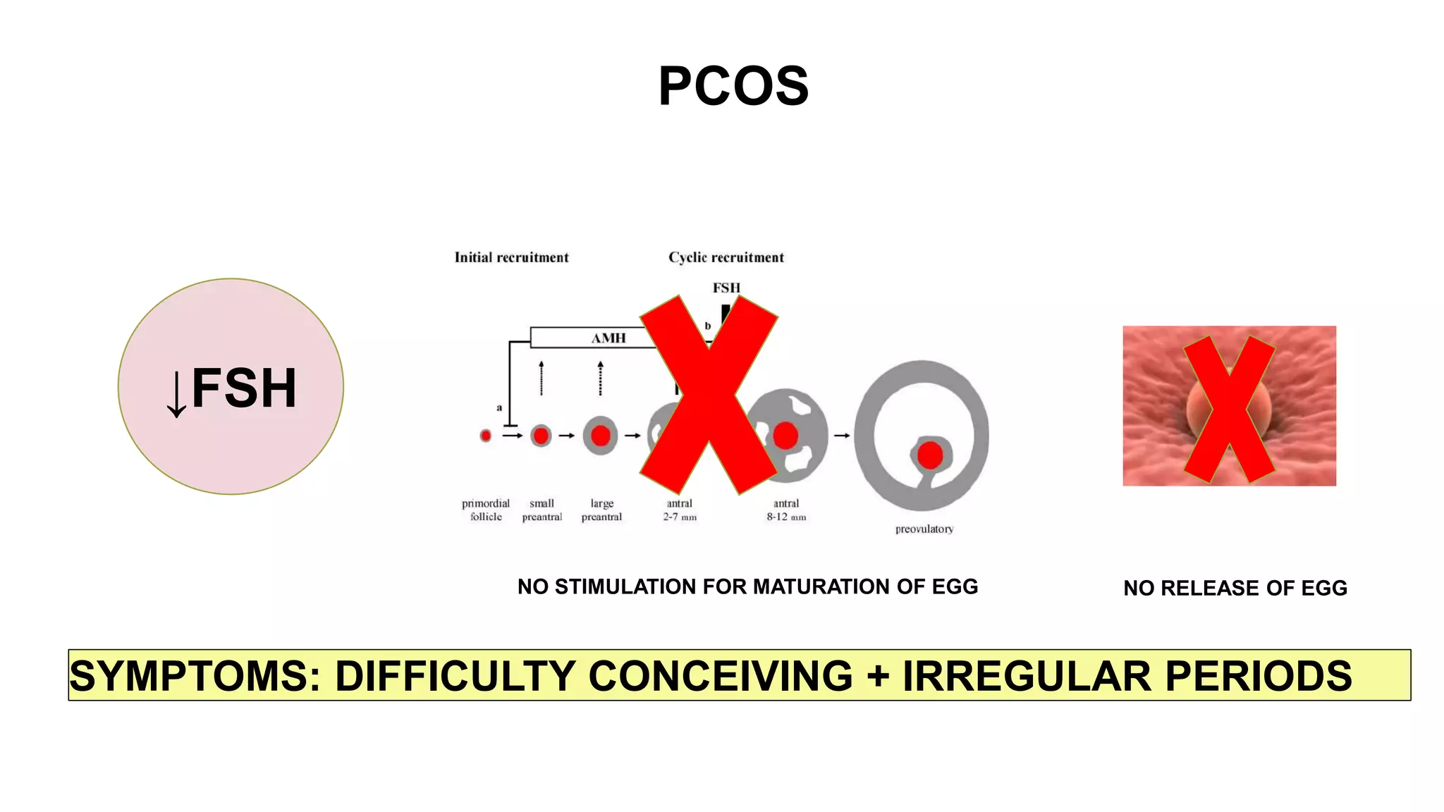 PCOS (Polycystic ovary syndrome) | PPTX