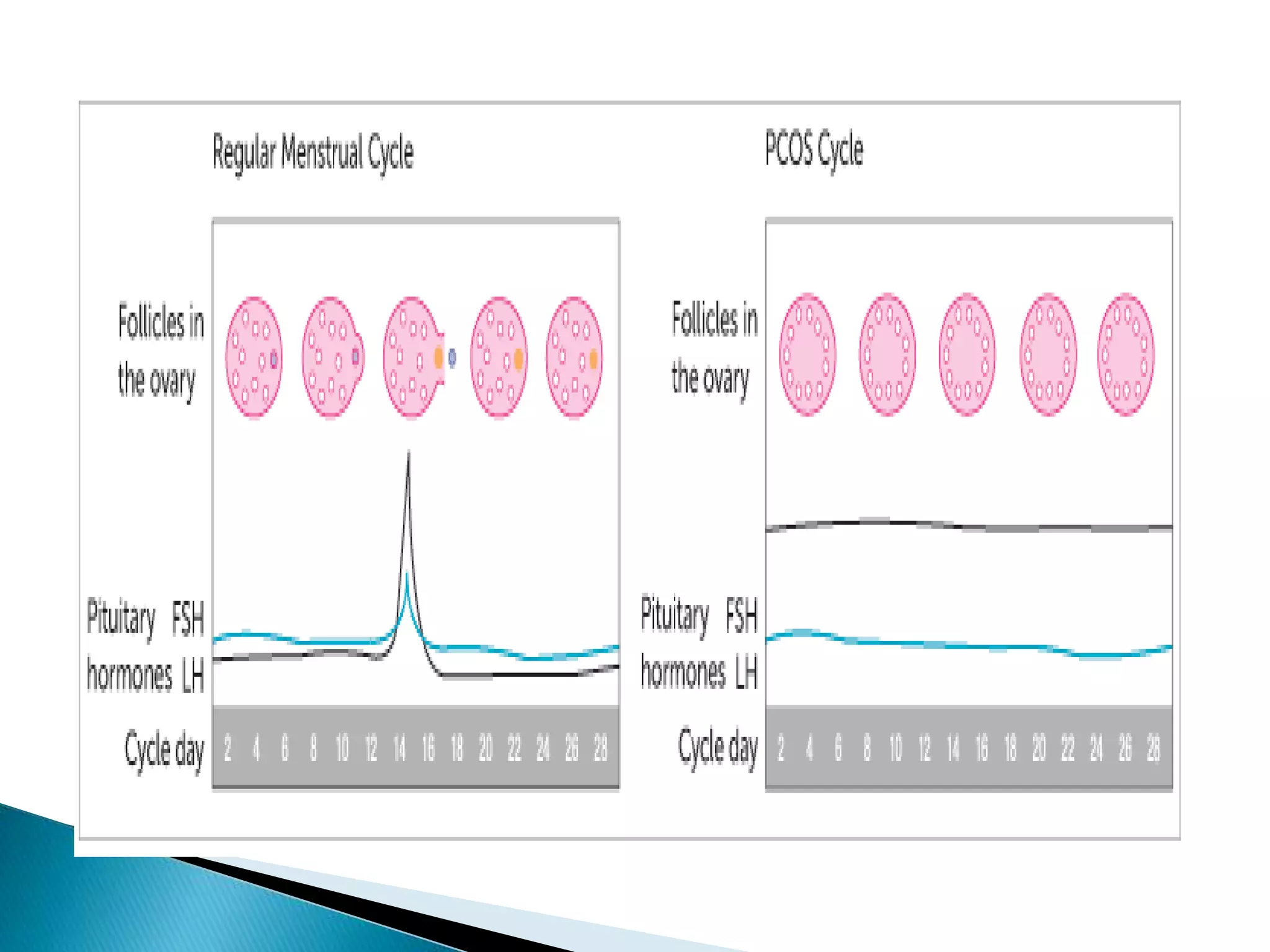 Pcos overview | PPT