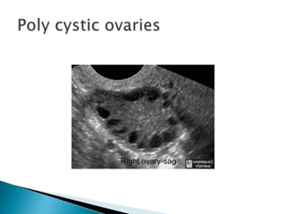 Pcos overview | PPTX