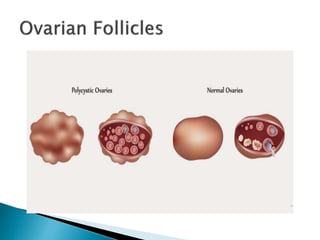 Pcos overview | PPTX