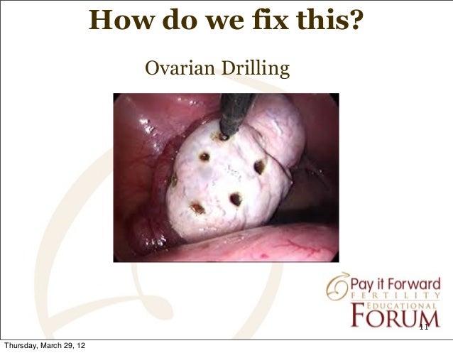 Polycystic Ovary Syndome (PCOS) and Fertility