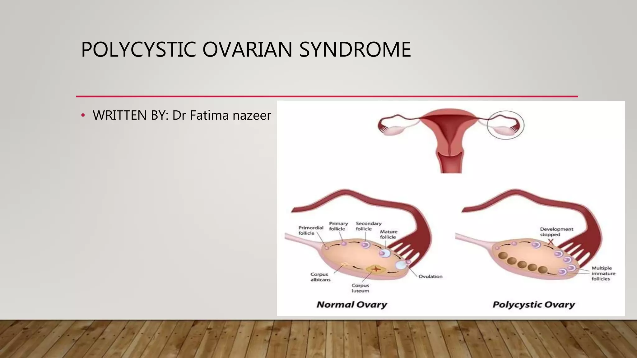 pcos presentation .pptx