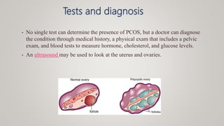 pcos presentation .pptx