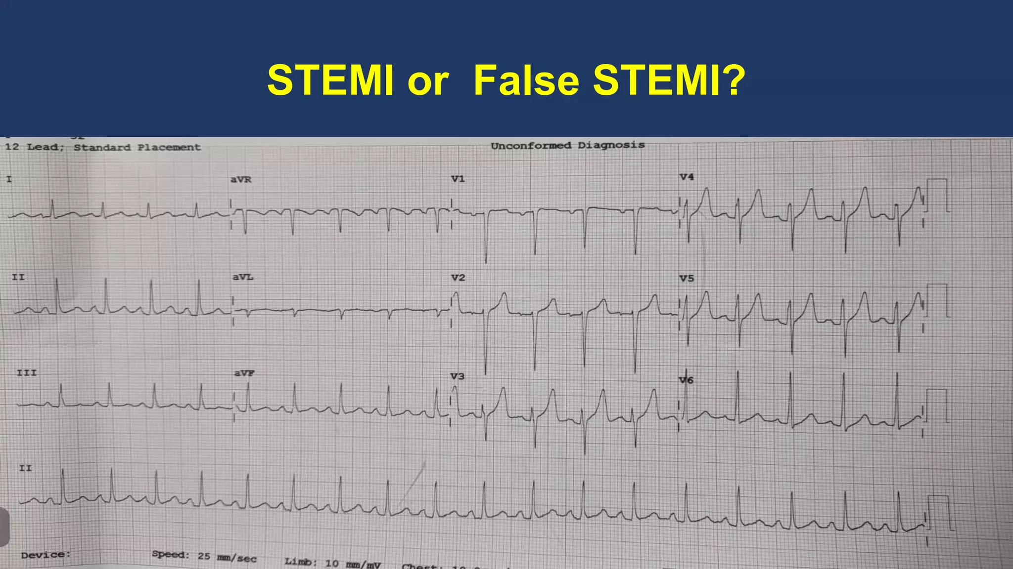PCP IN STEMI.pptx
