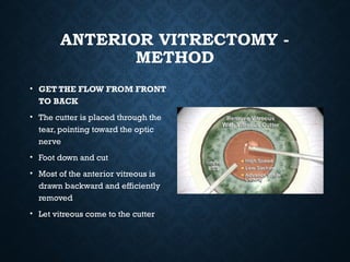 PCR and anterior vitrectomy management .pptx