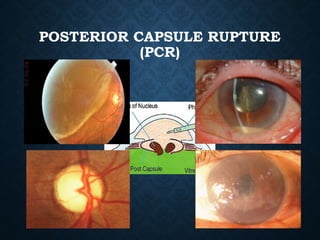 PCR and anterior vitrectomy management .pptx