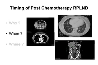 ECCLU 2011 - N. Clarke - Testicular cancer - Role of surgery in the ...