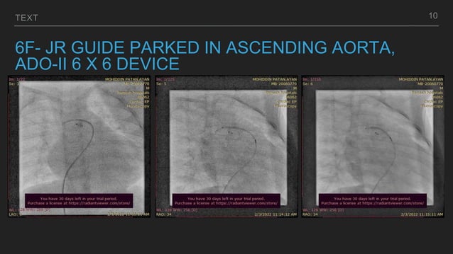 PERCUTANEOUS DEVICE CLOSURE OF AORTO- PULMONARY WINDOW (RESIDUAL) | PPTX
