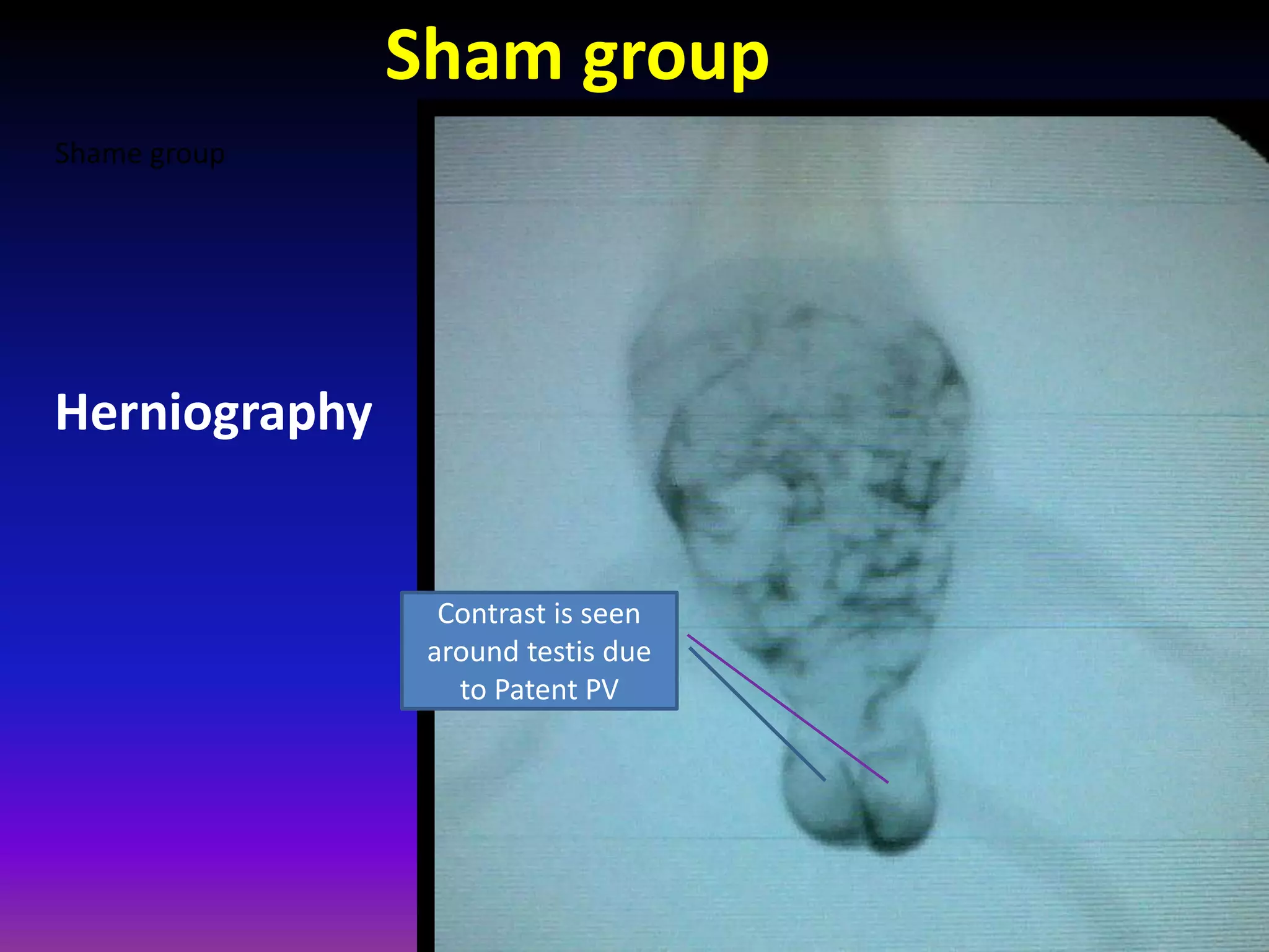Percutaneous Oblitration ofpatent process vaginalis : a rat model for ...