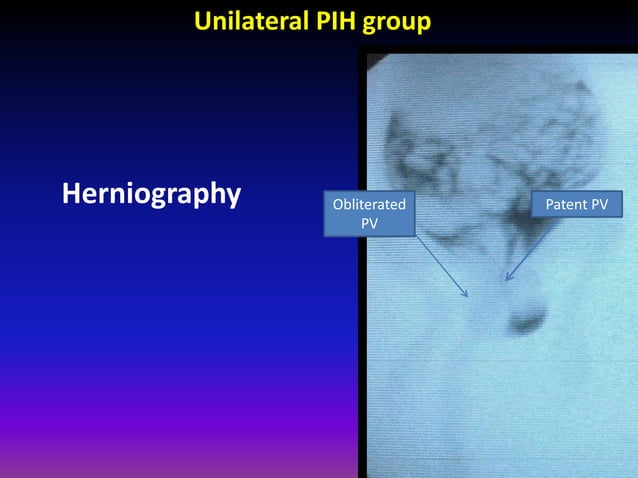 Percutaneous Oblitration ofpatent process vaginalis : a rat model for ...