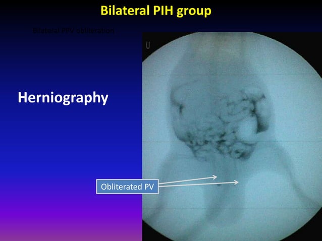 Percutaneous Oblitration ofpatent process vaginalis : a rat model for ...