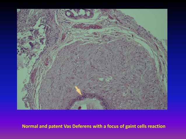 Percutaneous Oblitration ofpatent process vaginalis : a rat model for ...
