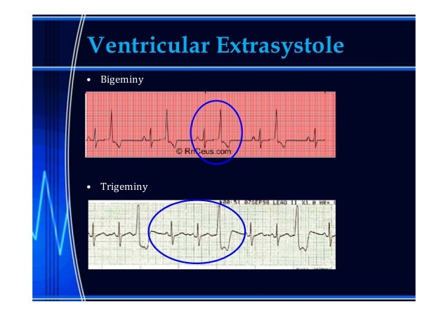 Electrical Instability in ACS