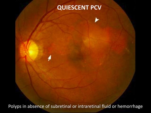 Polypoidal choroidal vasculopathy | PPTX | Eye and Vision Conditions | Diseases and Conditions