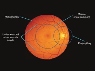 Polypoidal choroidal vasculopathy | PPTX