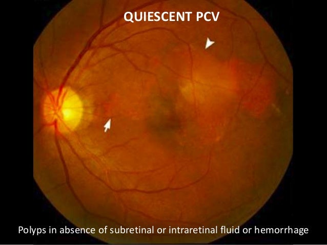 Polypoidal choroidal vasculopathy