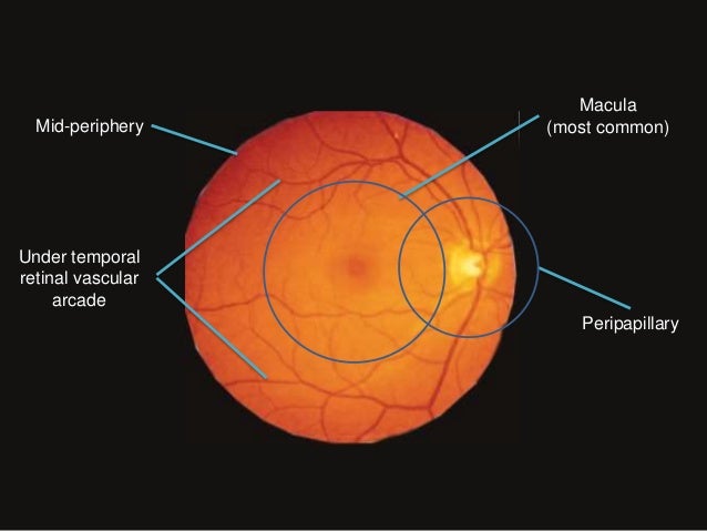 Polypoidal choroidal vasculopathy
