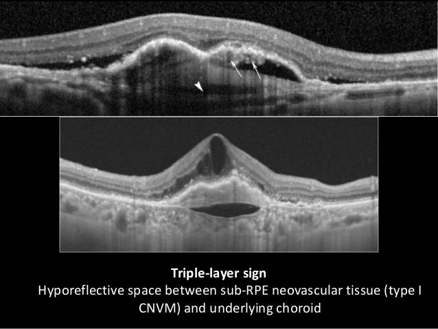 Polypoidal choroidal vasculopathy